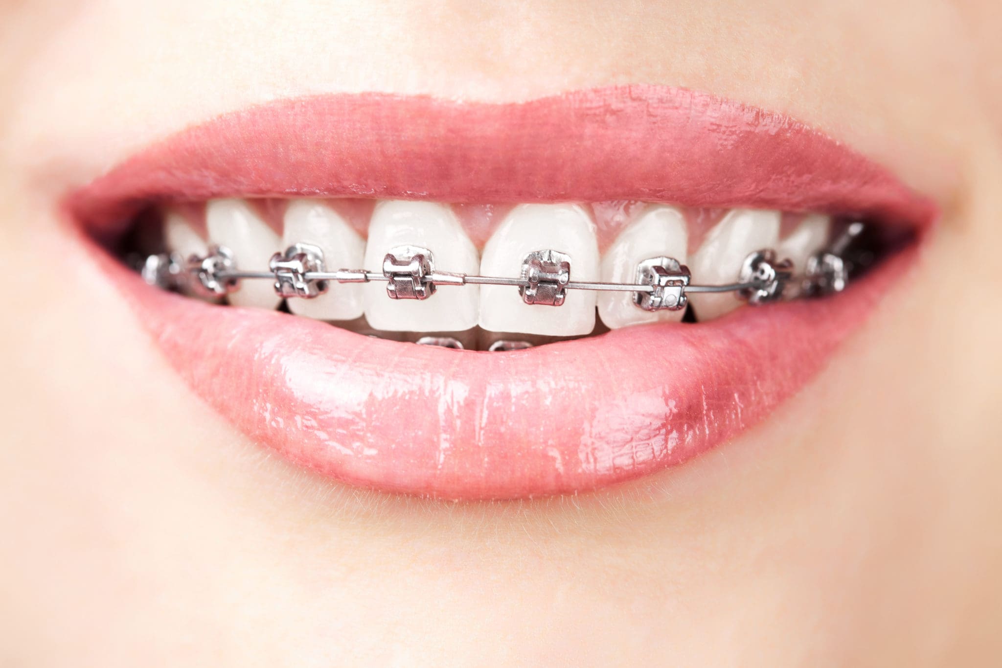 Brackets autoligables - Clinica Dental Dentisalud
